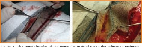 Figure 1 From Getting Maximum Follicular Units To Do A Megasession Through A Scalp Elasticity