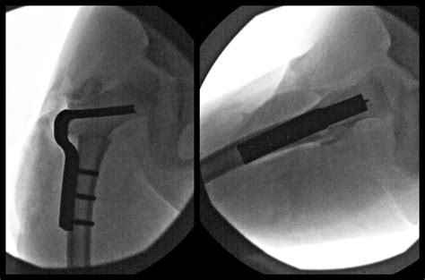 Varus Derotational Osteotomy Of Proximal Femur