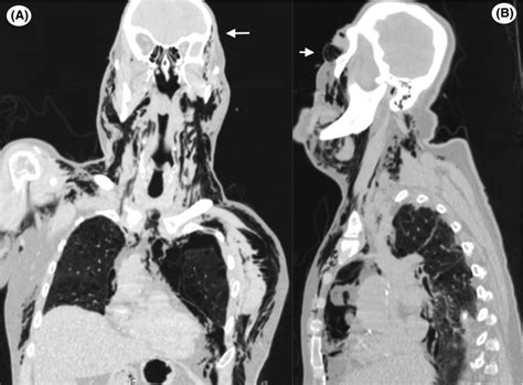 A Computed Tomography Scan Demonstrating The Extension Of The Download Scientific Diagram
