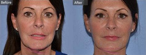Before After Photos Of A Facelift That Removes 10 Years Of Aging In 30 Minutes Yourtango