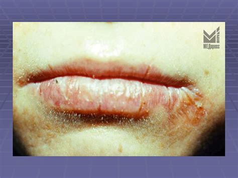 Изменения слизистой полости рта при инфекционных и соматических заболеваниях презентация онлайн