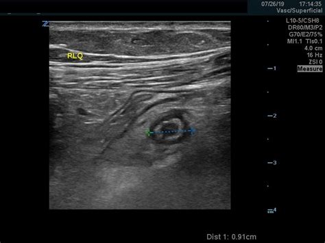 Ruptured Appendix Ultrasound
