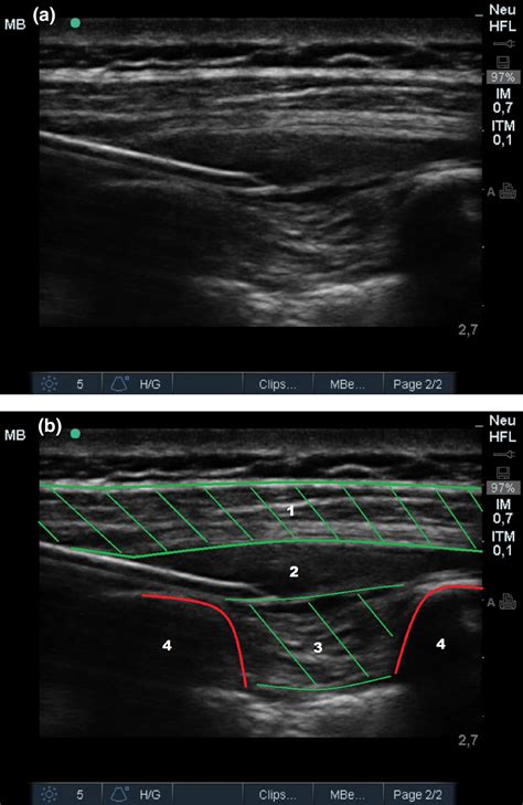 Intercostal Paraspinal Nerve Block For Thoracic Surgery Roué 2016 Anaesthesia Wiley