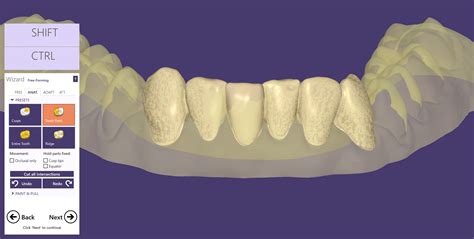 Provisional Module CAD Exocad