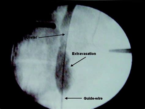 Ntraoperative Fluoroscopy Showing Contrast Extravasation After Balloon Download Scientific