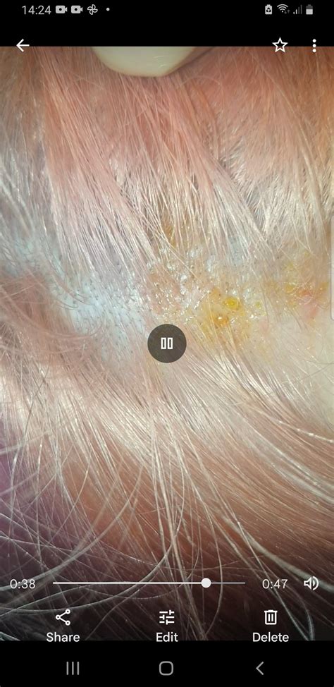 Scalp Burned With Bleach Should I Go To Doctor Tomorrow R Medical