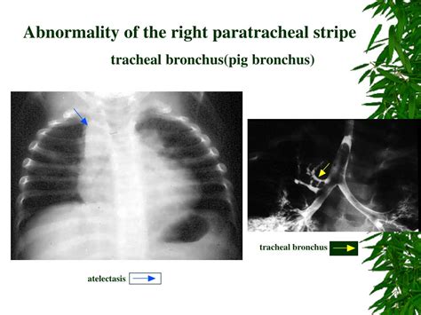 Ppt Practical Approach To The Pediatric Chest Xray Powerpoint