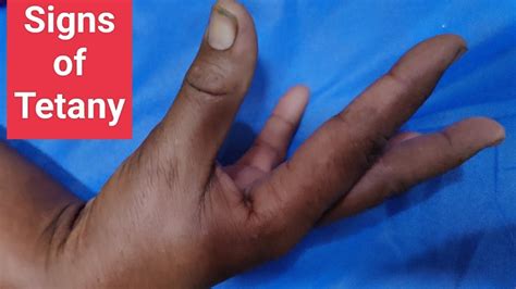 Signs Of Tetany Early Warning Symptoms You Shouldnt Ignore Youtube