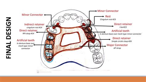 Applied Aspects Of Cast Partial Denture Designingpptx