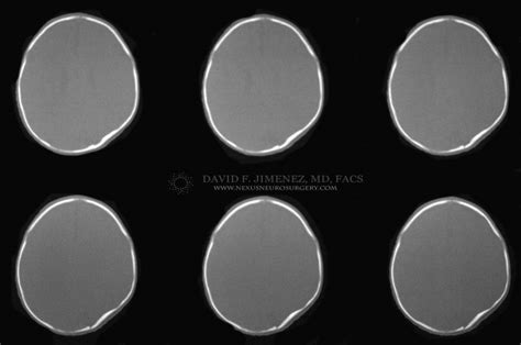 Lambdoid Synostosis Facts And Photos Craniosynostosis