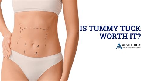 Is Tummy Tuck Worth It