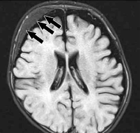 Ten Seconds Eeg Epoch Sleep Record At 5 Months Age Shows A Normal