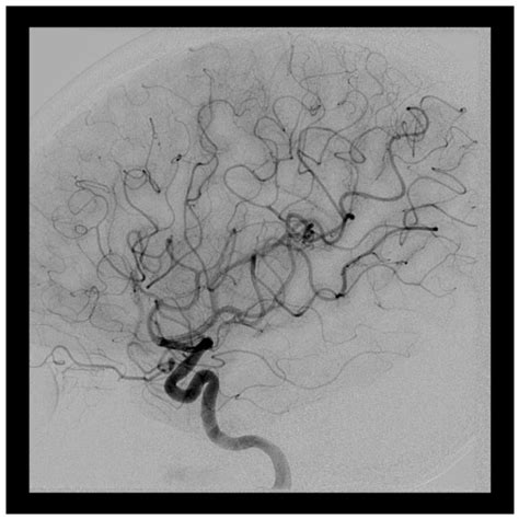 Factors Affecting The Obliteration Rate Of Intracranial Aneurysms