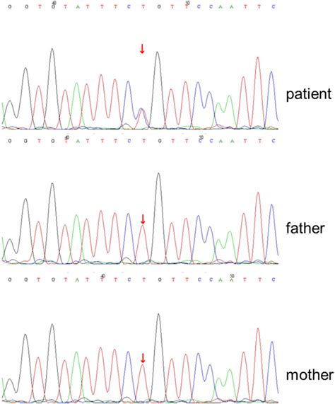 Case Report A Stat1 Gain Of Function Mutation Causes A Syndrome Of