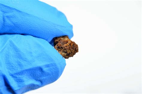 Laser Lithotripsy In Turkey Laser Lithotripsy Costs 2025