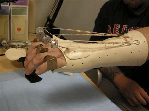 Finger Extensor Tendon Injury Splint At Julian Byrd Blog