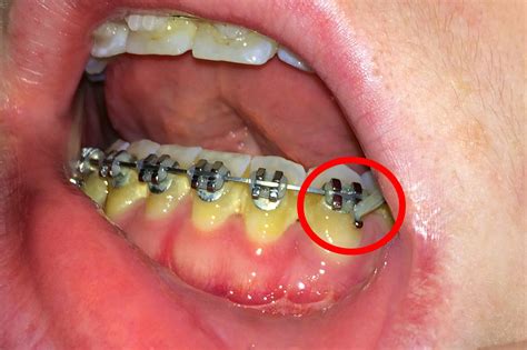 Braces Have Hooks At Lori Birdwell Blog