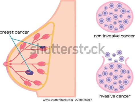 Illustrated Illustration Breast Cancer Stock Vector Royalty Free