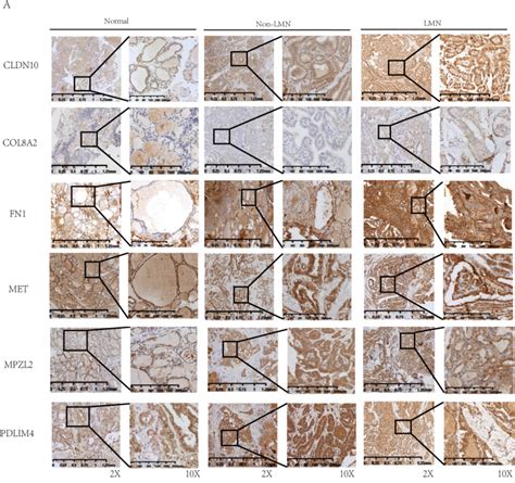Identification Of Novel Gene Signature Predicting Lymph Node Metastasis In Papillary Thyroid