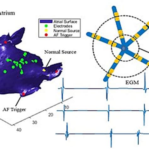 Illustration Of Simulated Catheter And Intracardial Electrogram In