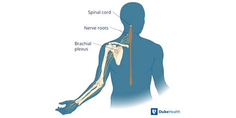 Brachial Plexus Nerve Impingement