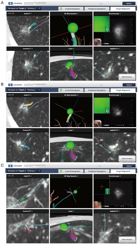 Images From Enb Operation Enb Biopsies Of A A 19 Cm Diameter Ground