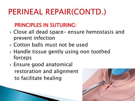 Episiotomy And Its Repair Pptx