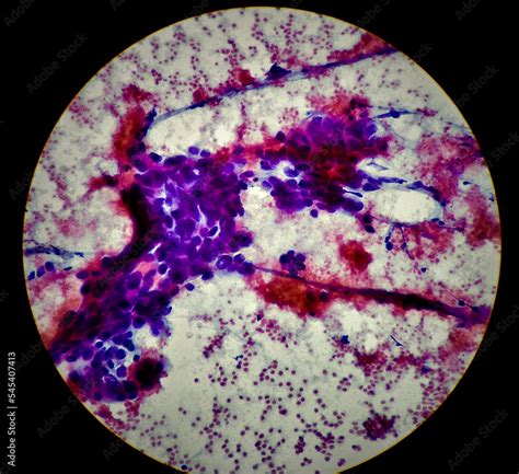 Intra Abdominal Masscytology Spindle Cell Sarcoma Positive Malignant Cells Pleomorphic