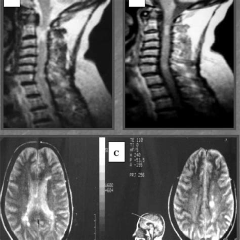 Pdf Late Onset Multiple Sclerosis