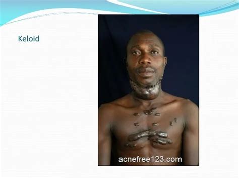Ppt Keloid Scars Treatment Powerpoint Presentation Free Download