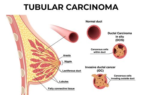 25 Facts About Mucinous Carcinoma Of The Breast