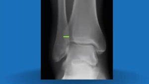 Malleolar Ankle Fracture Radiographic Evaluation Part 5 Tibiofibular Overlap VuMedi