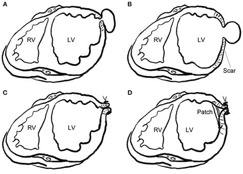 Frontiers Surgical And Conservative Treatment Of Post Infarction Left Ventricular Pseudoaneurysm