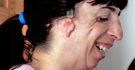 Brave Woman Born Without Ears Or Cheekbones Told To Take That Mask Off