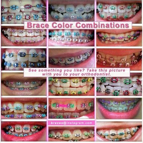 Best Braces Colors For Girls How To Choose Artofit