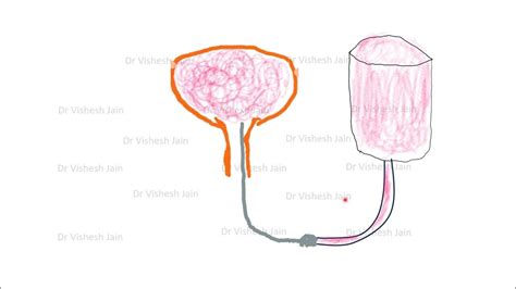 Micturating Cystourethrogram Mcu Vcug English Youtube