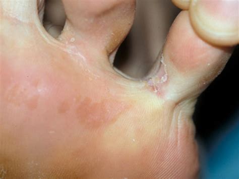 Una Strana “secchezza” Dei Piedi Potrebbe Trattarsi Di Una Micosi