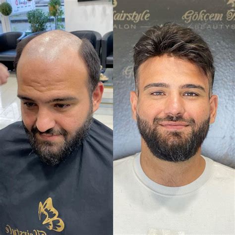 Hair Systems Before And After Toupee Hairstyles