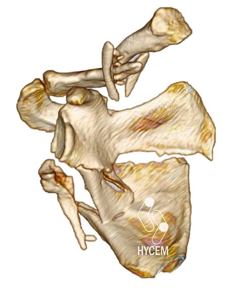 Fractura De Escápula Hycem
