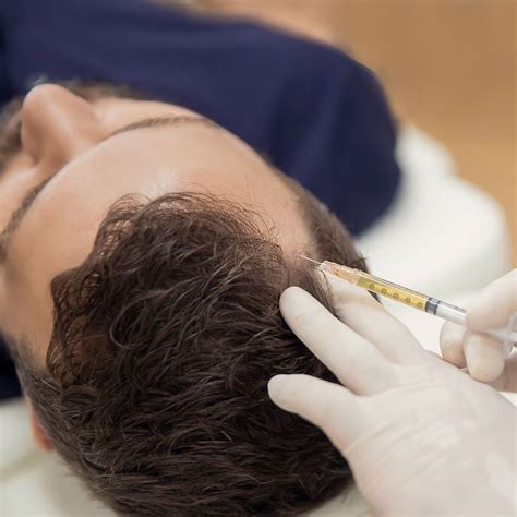 Prp Scalp Injection Full Innersource Medicine