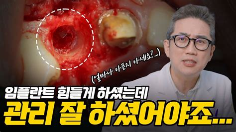 임플란트 하신 분들은 꼭 보세요 Youtube