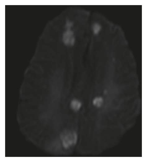 Image Of MRI Brain Showing Multifocal Areas Of Diffusion Restriction Download Scientific