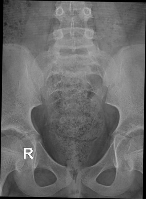 Pelvis Inlet X Ray At Ronnie Anderson Blog