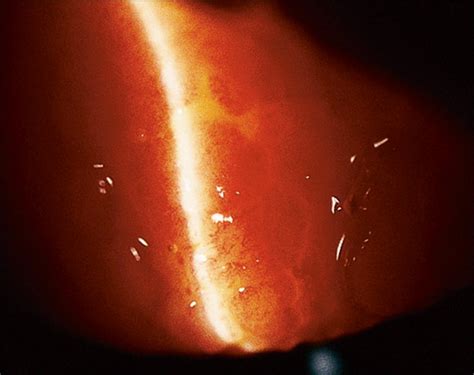Giant Papillary Conjunctivitis Clinical Tree