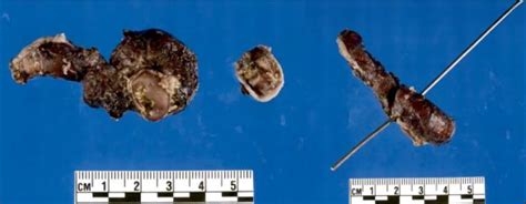 Pathologic Specimen Showing The Perforated Meckels Diverticulum That