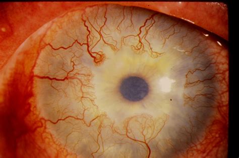 Corneal Neovascularization