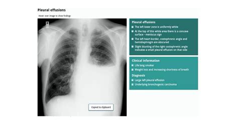 Chest X Ray Pptppt