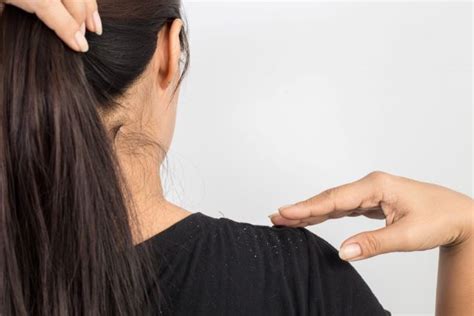 Dandruff VS Dry Scalp The Difference Causes Prevention Treatment U S Dermatology Partners