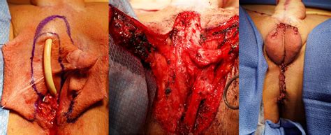 Options And Indications In Gender Affirming Phalloplasty Clinics In
