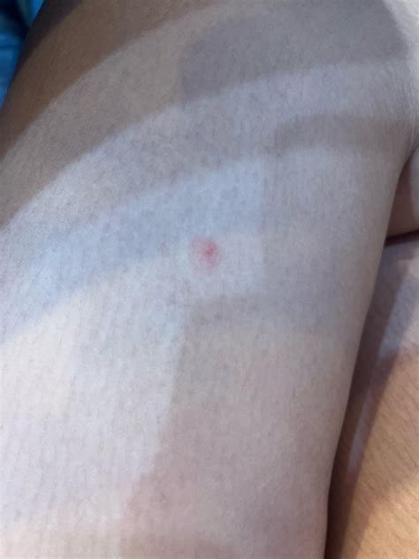 Are These Bedbug Bites Rwhatisthisbug